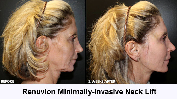 Renuvion Minimally Invasive Neck Lift Dr. Paul Ruff West End Plastic ... Renuvion Minimally Invasive Neck Lift Dr. Paul Ruff West End Plastic ...